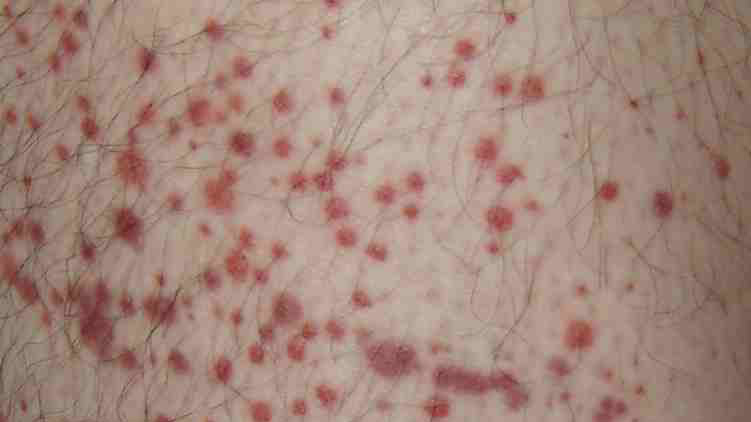 Petecchie: cosa sono, perché si presentano, come riconoscerle? Nei ...